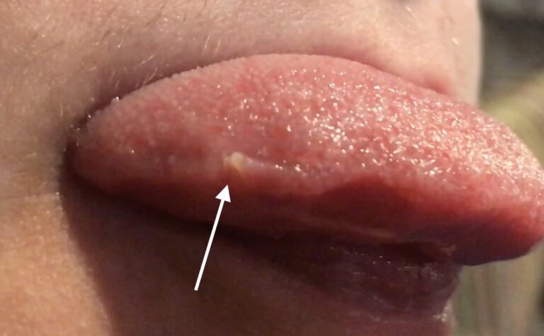 Transient Lingual Papillitis (Lie Bumps): Symptoms, Causes, Treatment ...