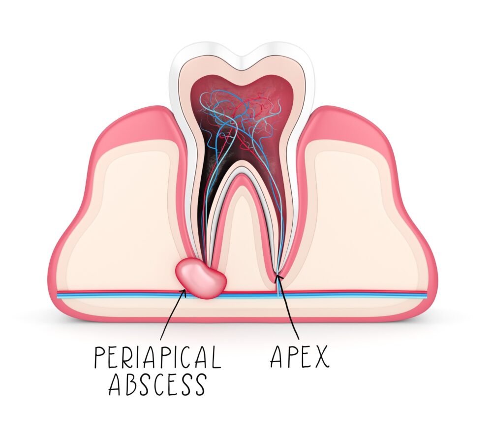 Periapical Abscess: Symptoms, Causes, Treatment – My Healthy Diet