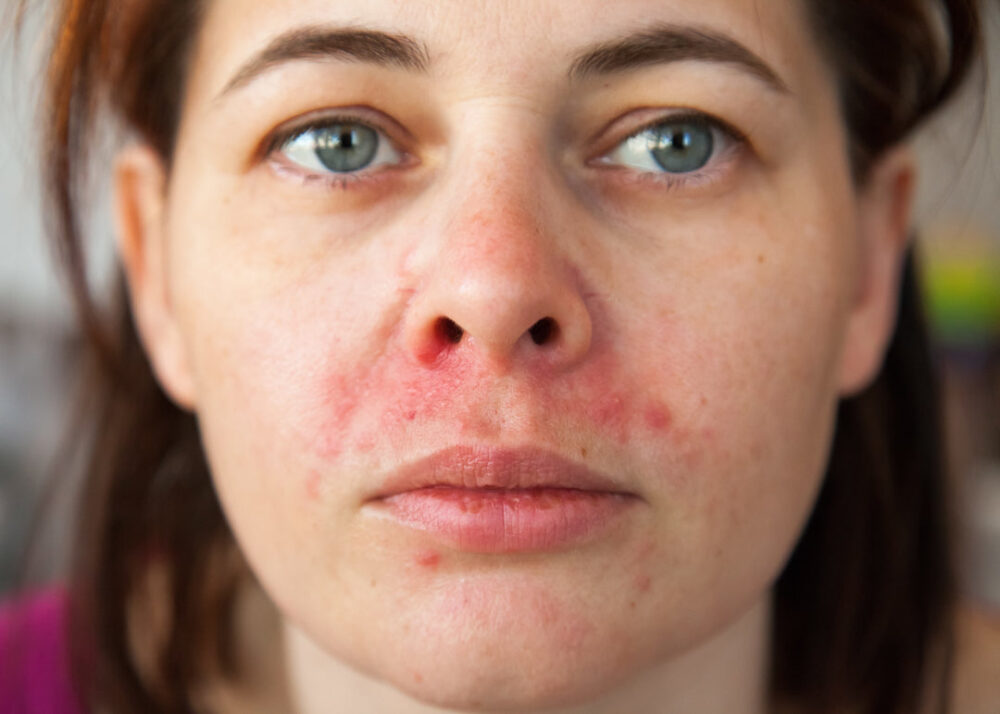 Perioral Dermatitis: Symptoms, Causes, Treatment – My Healthy Diet