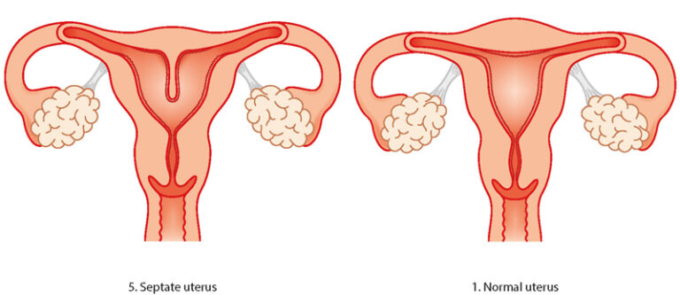 Septate Uterus: Symptoms, Causes, Treatment – My Healthy Diet