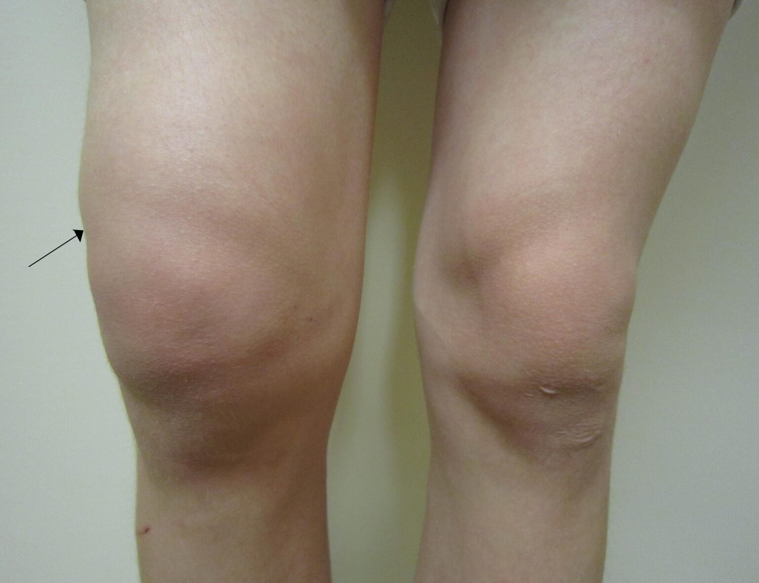 Swollen Knee: Symptoms, Causes, Treatment – My Healthy Diet