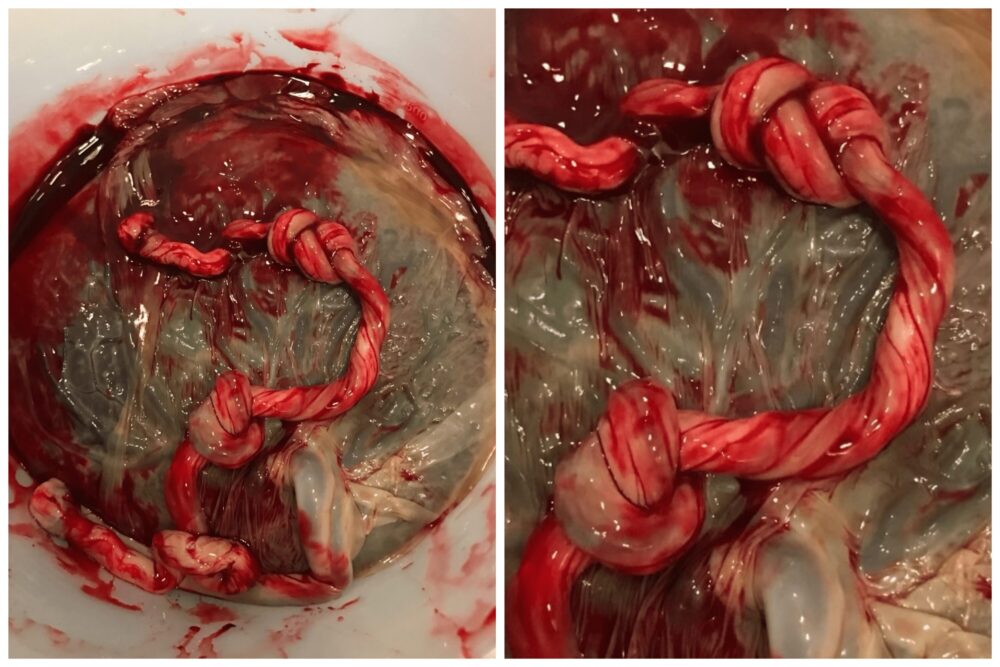 True Knot in Umbilical Cord: Symptoms, Causes, Treatment – My Healthy Diet