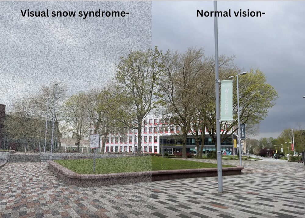 Visual Snow Syndrome: Symptoms, Causes, Treatment – My Healthy Diet