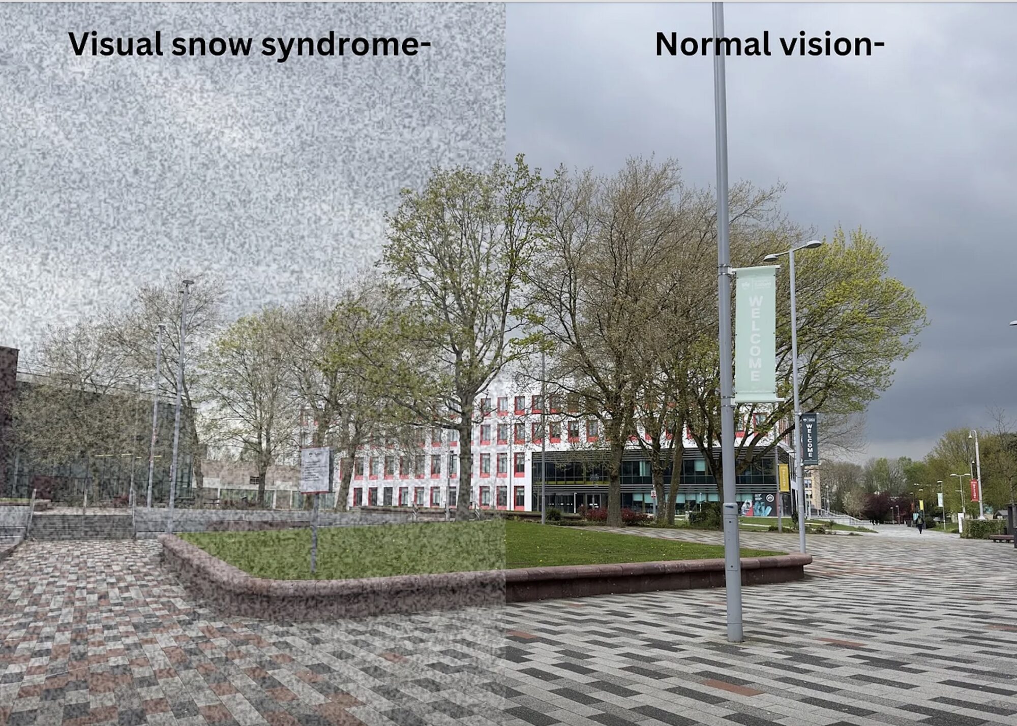 Visual Snow Syndrome: Symptoms, Causes, Treatment – My Healthy Diet